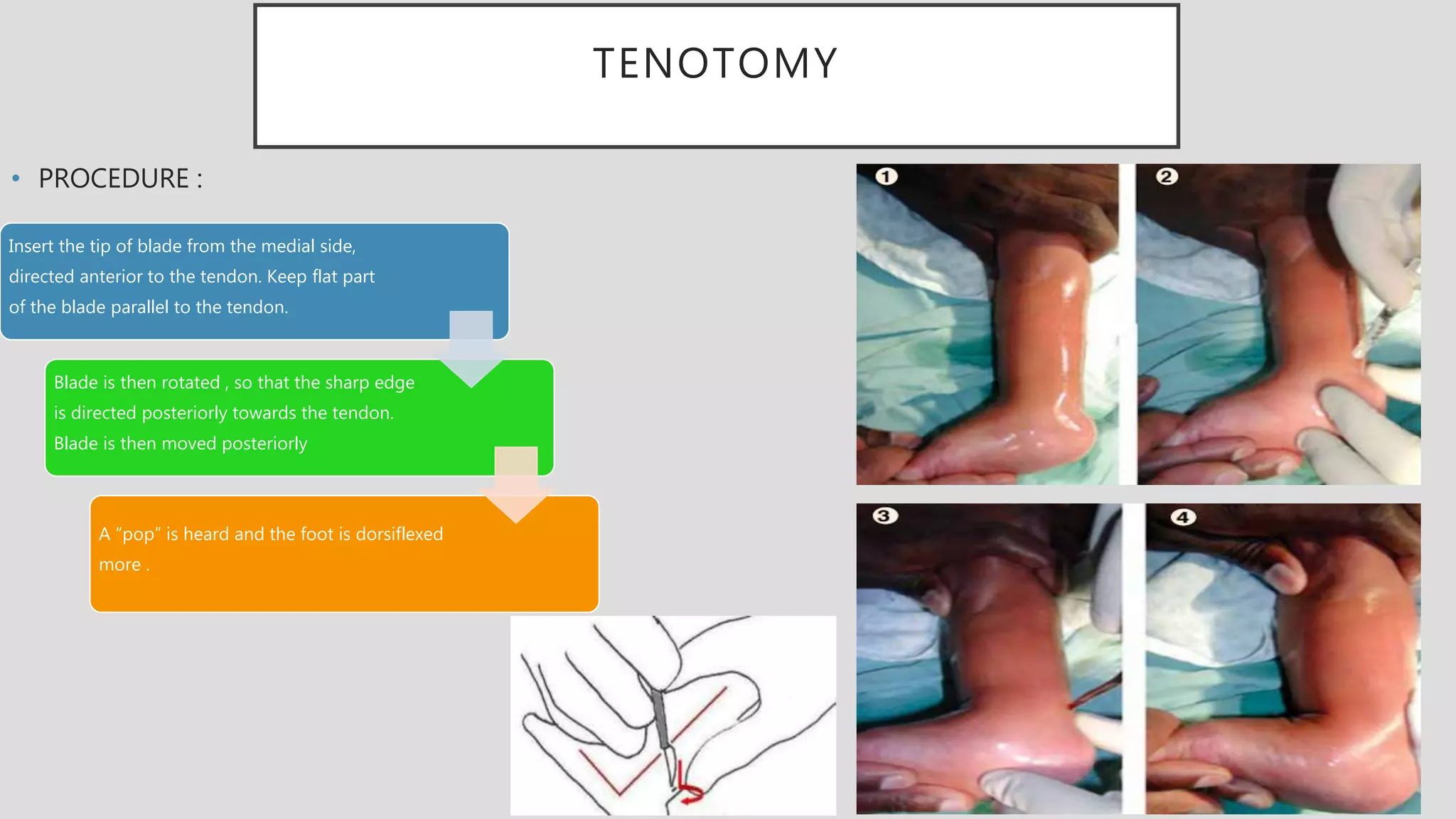 Ctev assessment & ponseti technique | PPTX