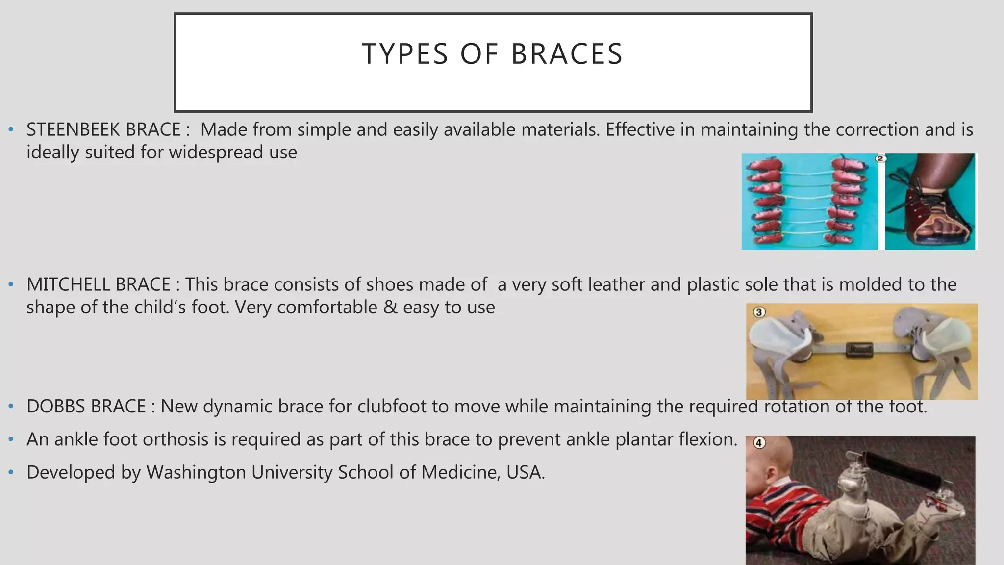 Ctev assessment & ponseti technique | PPTX