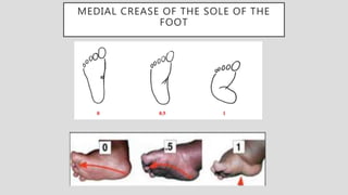 Ctev assessment & ponseti technique | PPTX