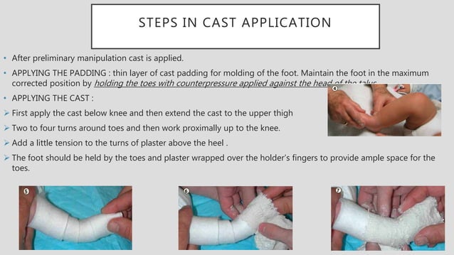 Ctev assessment & ponseti technique | PPTX