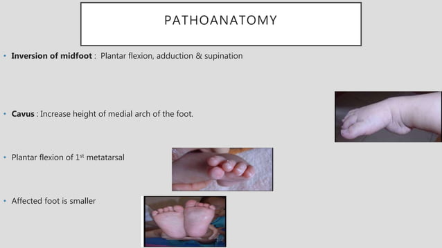 Ctev assessment & ponseti technique | PPTX