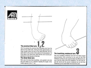 Ctev correction by umex frame | PPTX