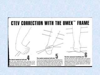 Ctev correction by umex frame | PPTX