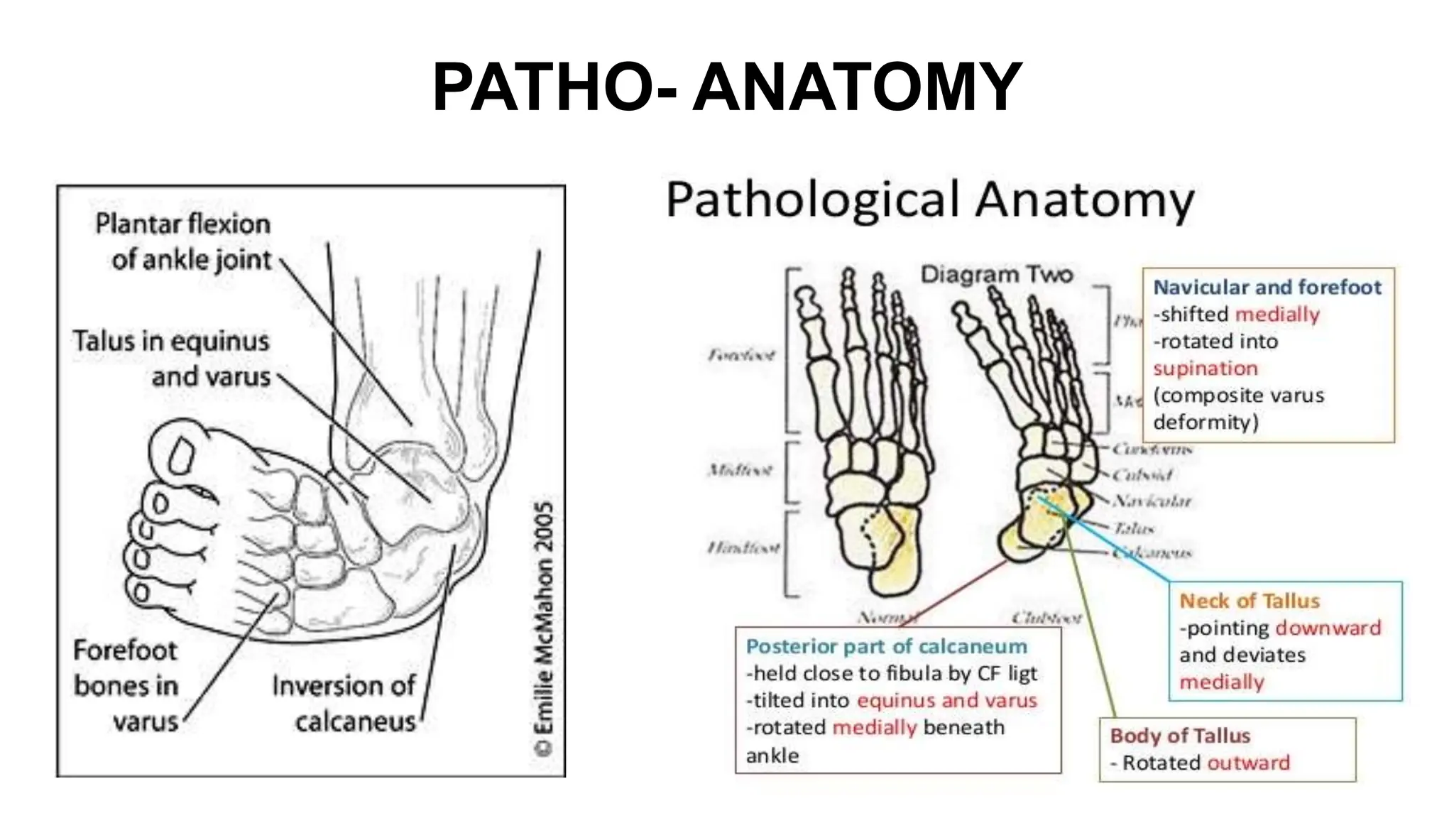 CTEV DEFORMITY.pptx