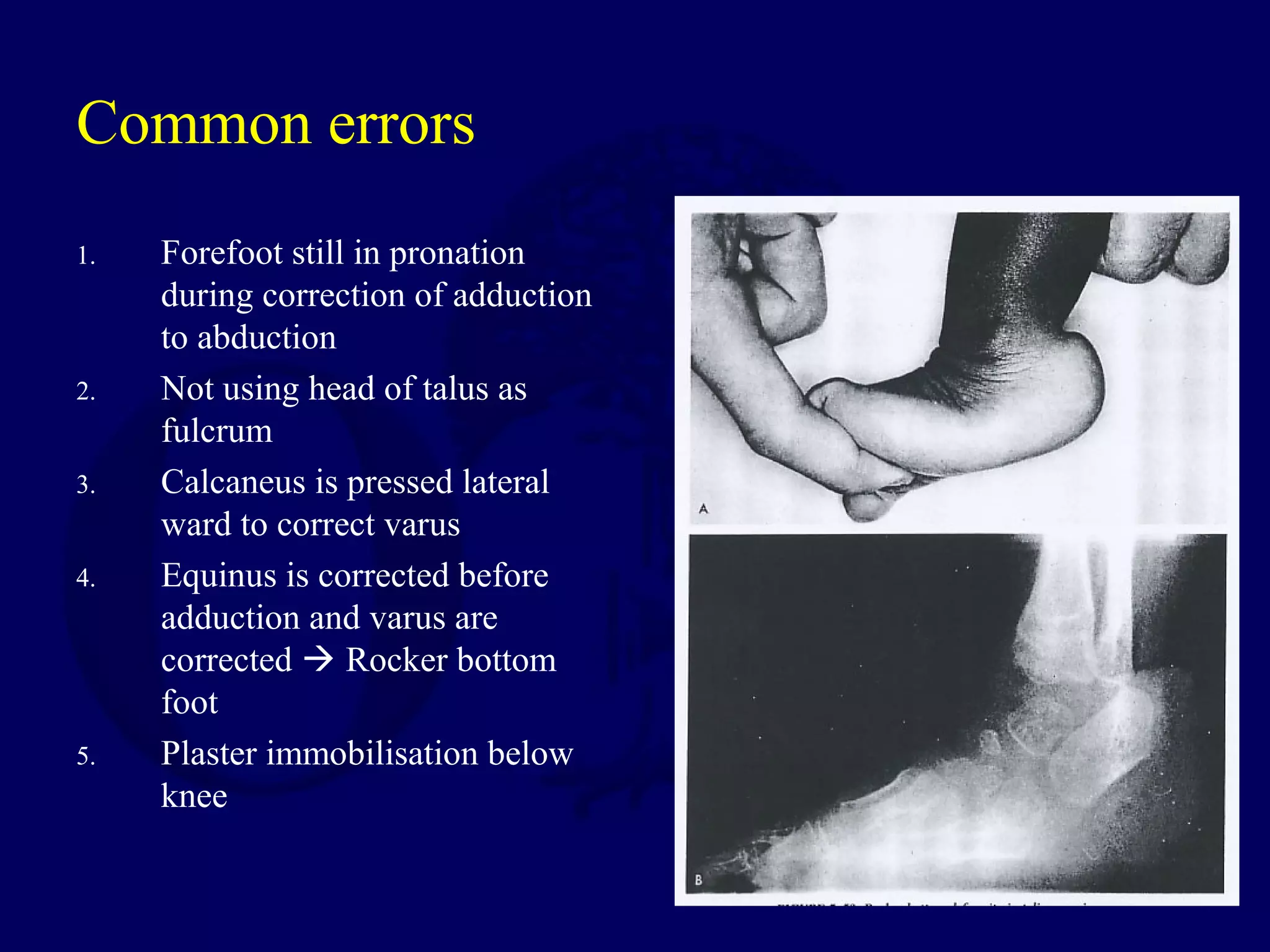 Surgical Versus Ponseti Approach for the Management of CTEV - Dr ...