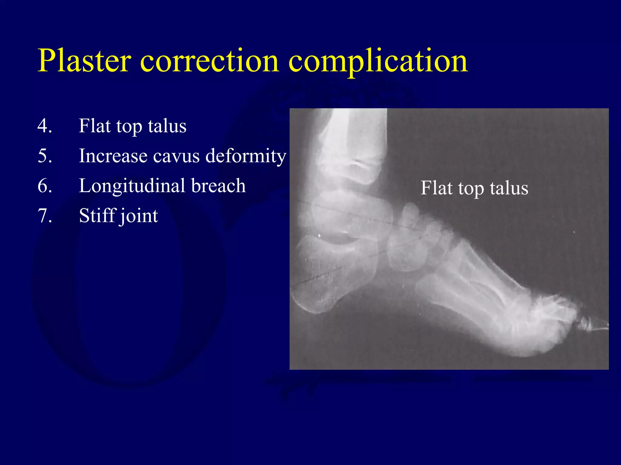 Surgical Versus Ponseti Approach for the Management of CTEV - Dr ...