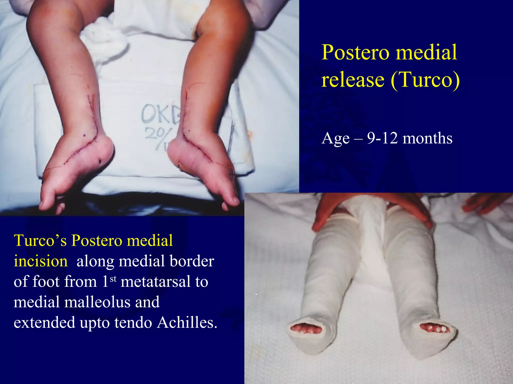 Surgical Versus Ponseti Approach for the Management of CTEV - Dr ...