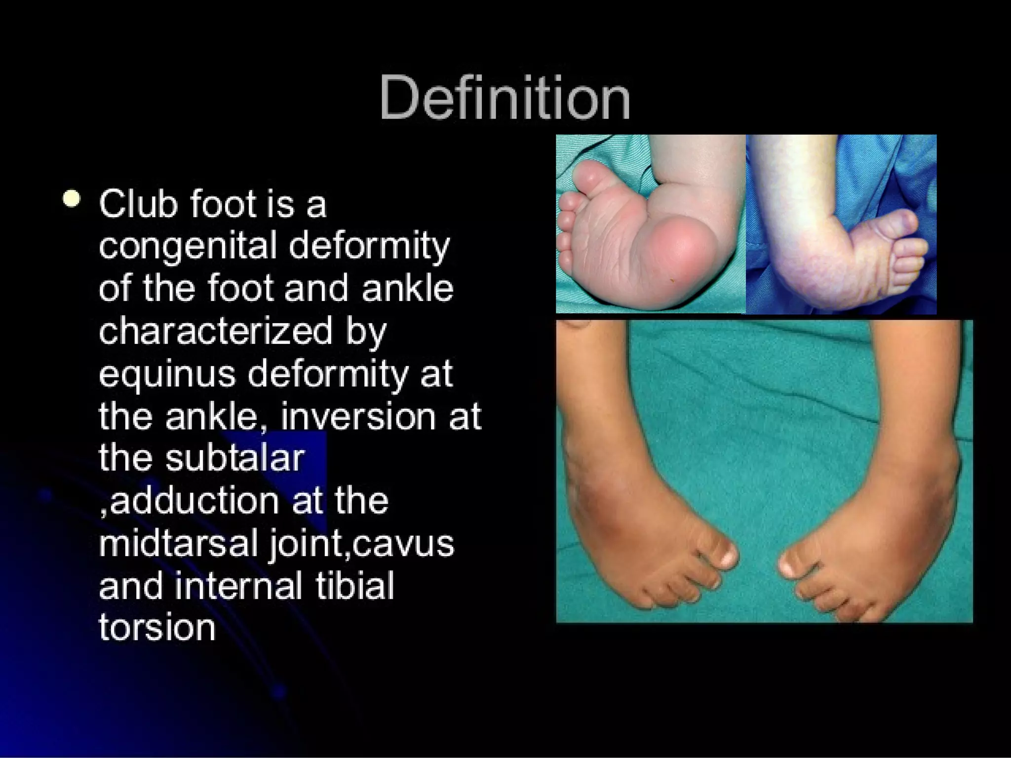 Surgical Versus Ponseti Approach for the Management of CTEV - Dr ...