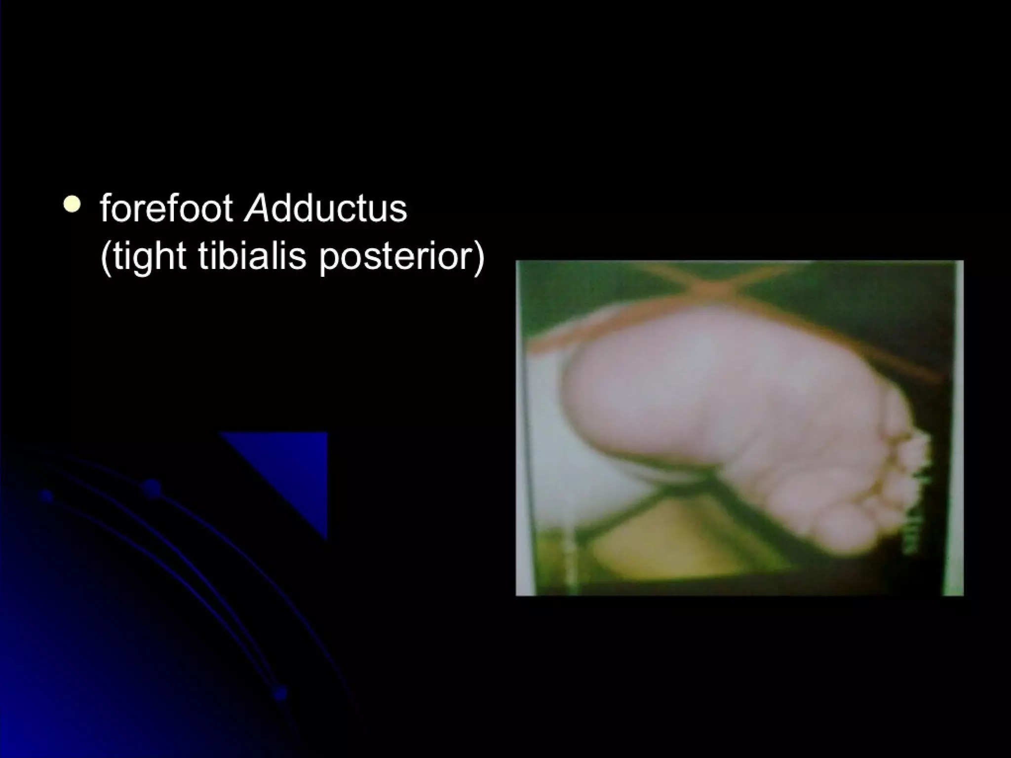 Surgical Versus Ponseti Approach for the Management of CTEV - Dr ...