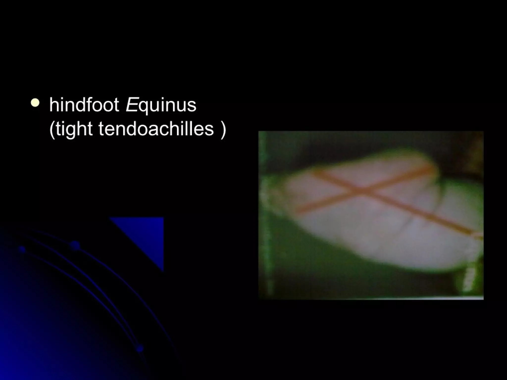 Surgical Versus Ponseti Approach for the Management of CTEV - Dr. CHINTAN N. PATEL | PPT