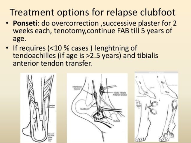 Surgical Versus Ponseti Approach for the Management of CTEV - Dr ...