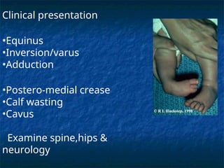 Congenital Talipes Equino Varus Deformity | PPT