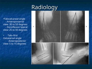 Congenital Talipes Equino Varus Deformity | PPT