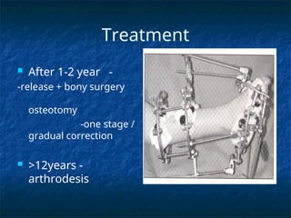 Congenital Talipes Equino Varus Deformity | PPT