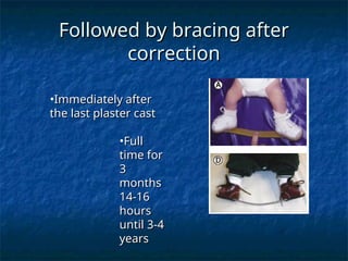Congenital Talipes Equino Varus Deformity | PPT