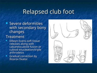 Congenital Talipes Equino Varus Deformity | PPT