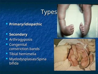 Congenital Talipes Equino Varus Deformity | PPT