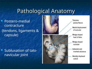 Congenital Talipes Equino Varus Deformity | PPT