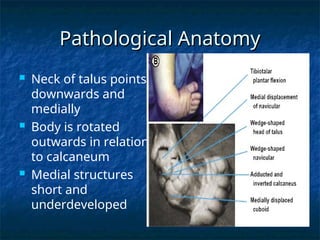 Congenital Talipes Equino Varus Deformity | PPT