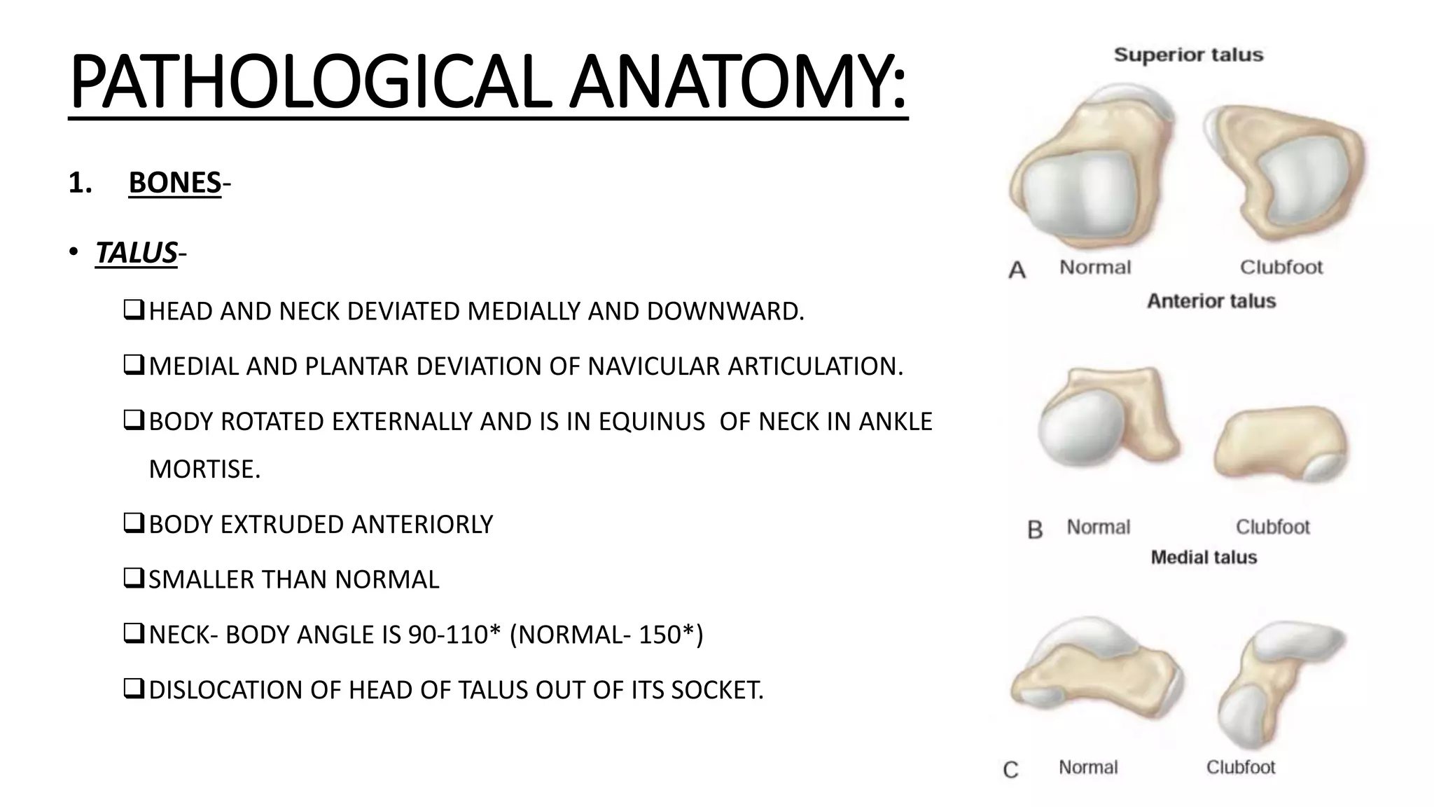 Congenital talipes equinovarus (club foot/ctev) ppt by Dr Pratik | PPTX
