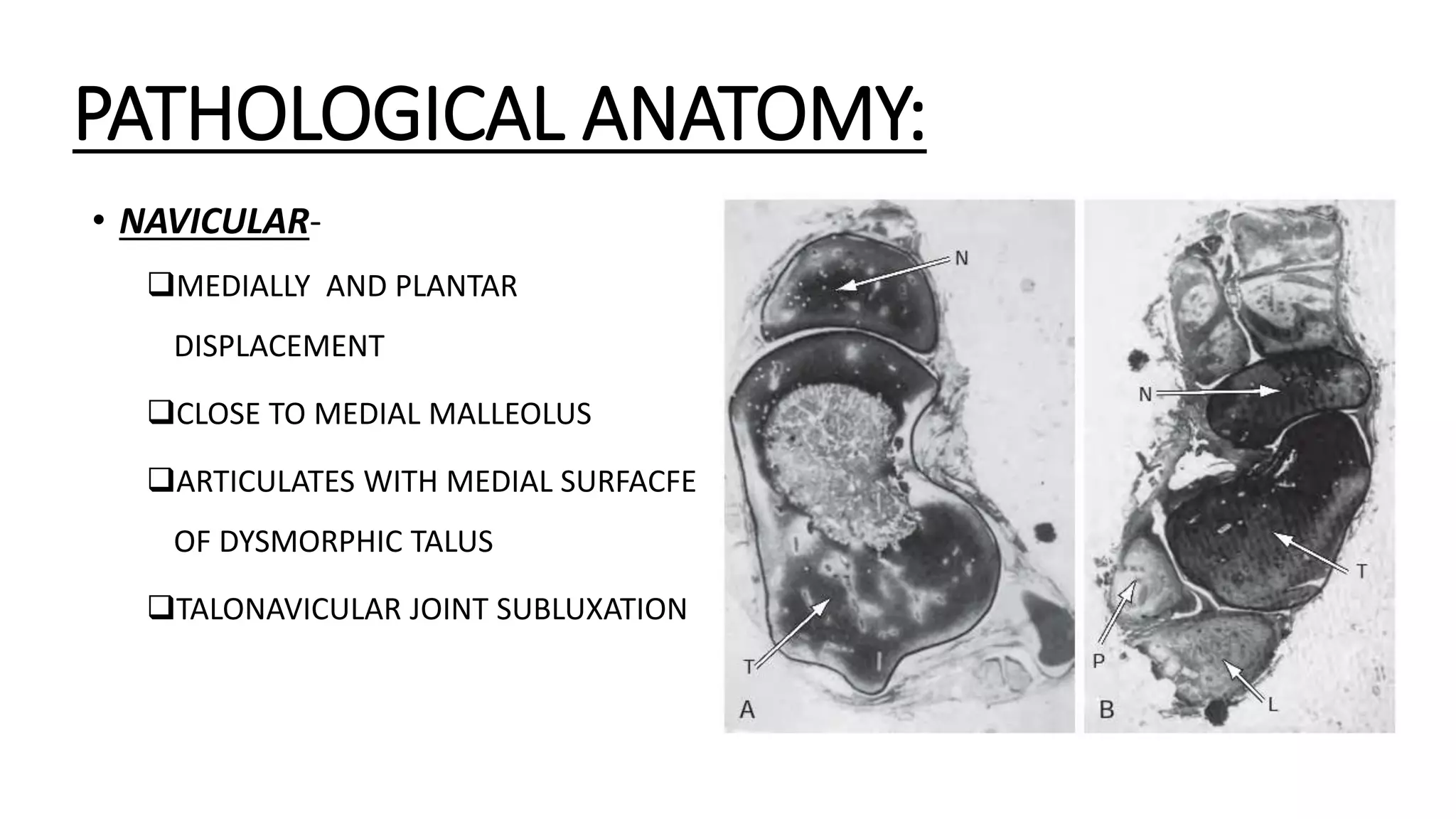 Congenital talipes equinovarus (club foot/ctev) ppt by Dr Pratik | PPTX