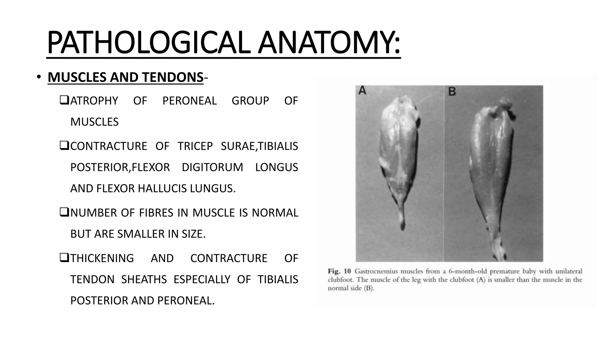 Congenital talipes equinovarus (club foot/ctev) ppt by Dr Pratik | PPTX