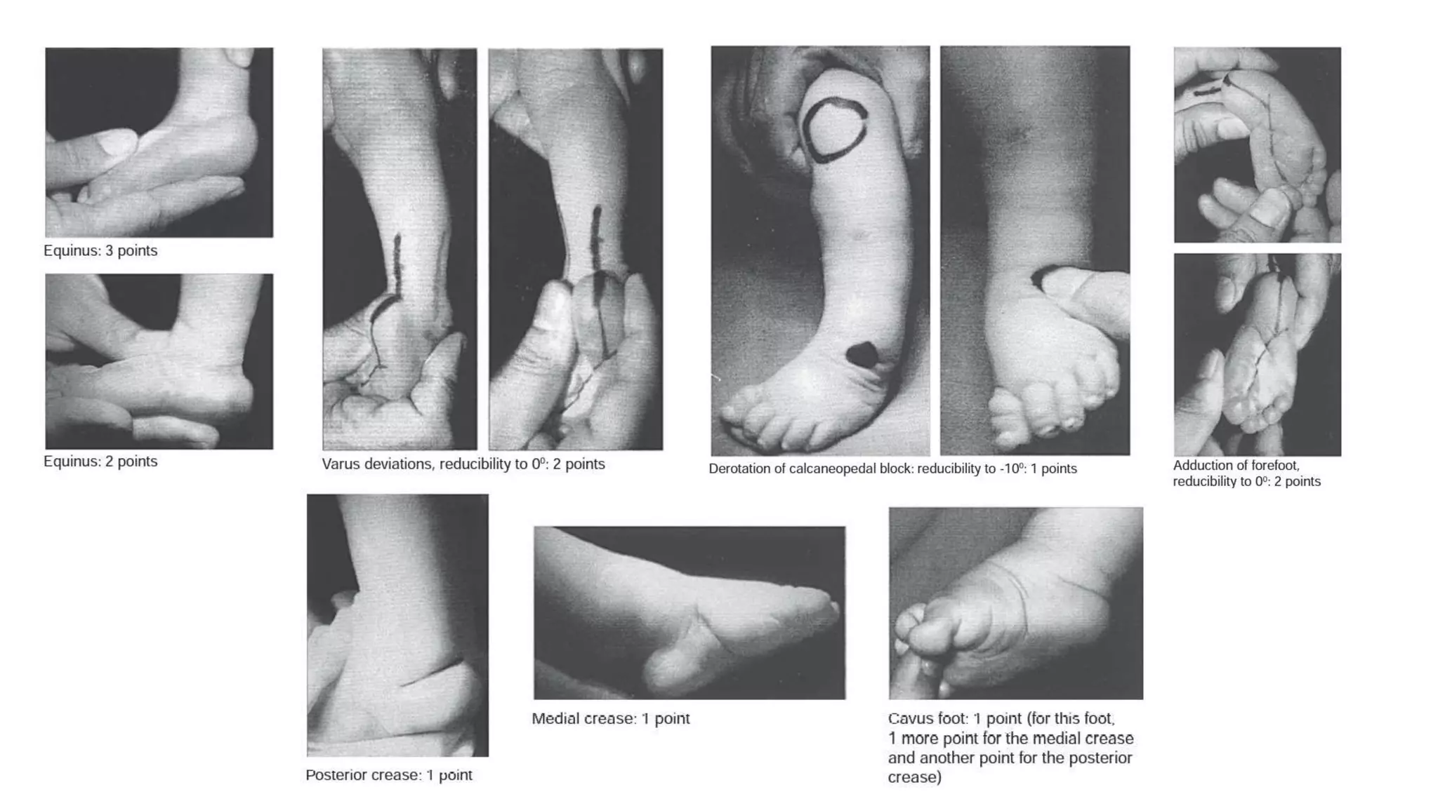 Congenital talipes equinovarus (club foot/ctev) ppt by Dr Pratik | PPTX