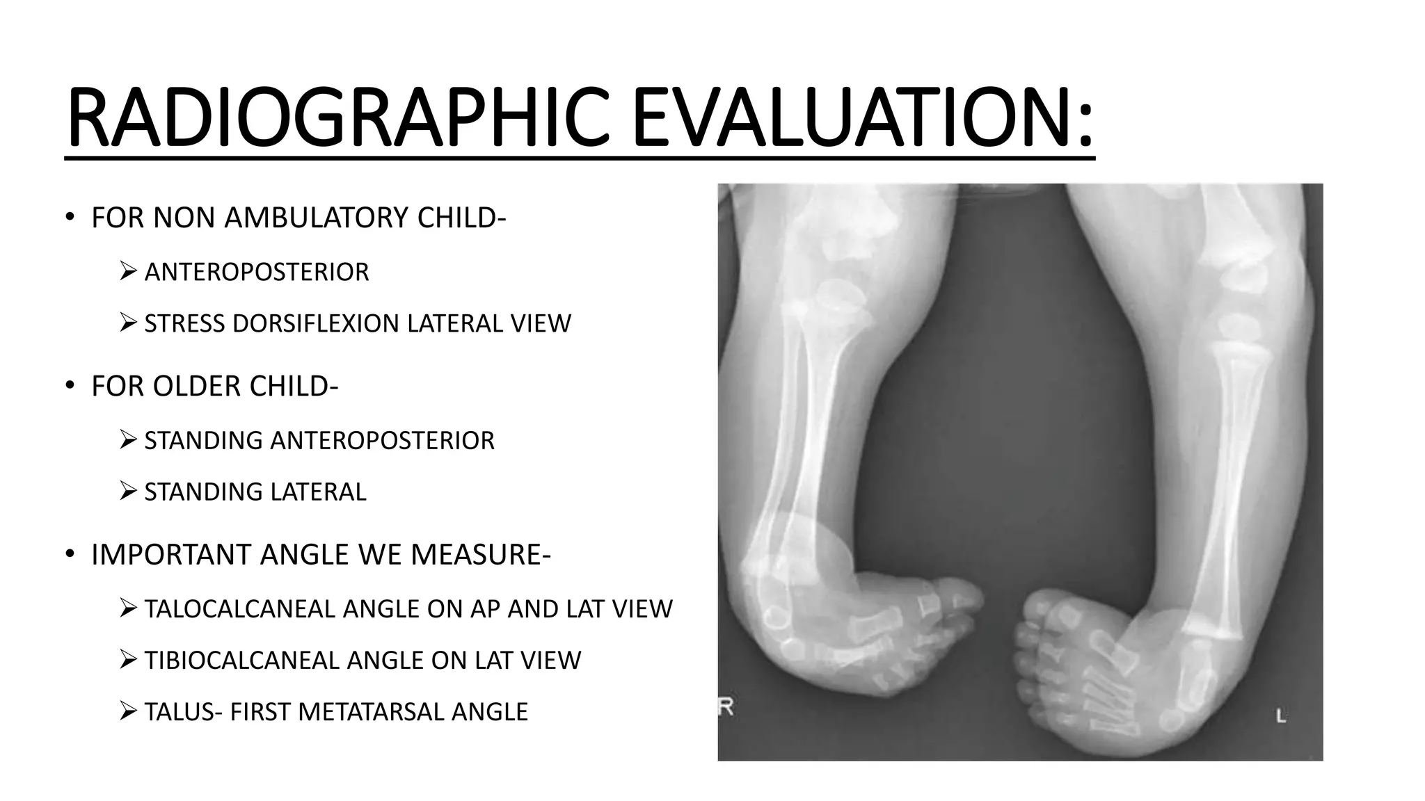 Congenital talipes equinovarus (club foot/ctev) ppt by Dr Pratik | PPTX