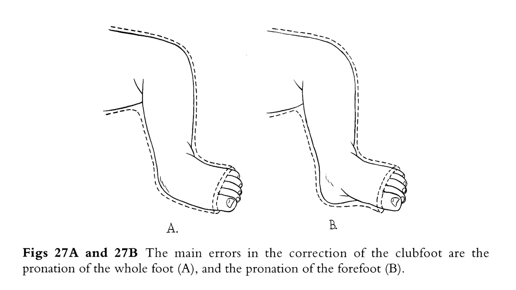 Congenital talipes equinovarus (club foot/ctev) ppt by Dr Pratik | PPTX