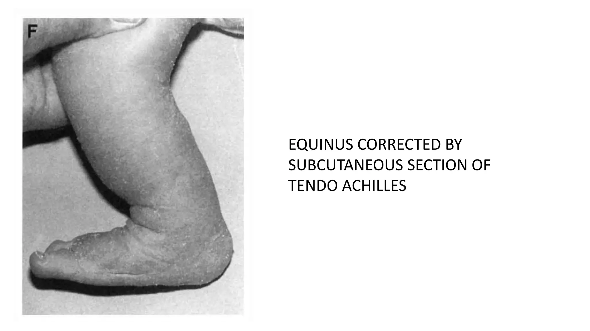 Congenital talipes equinovarus (club foot/ctev) ppt by Dr Pratik | PPTX ...