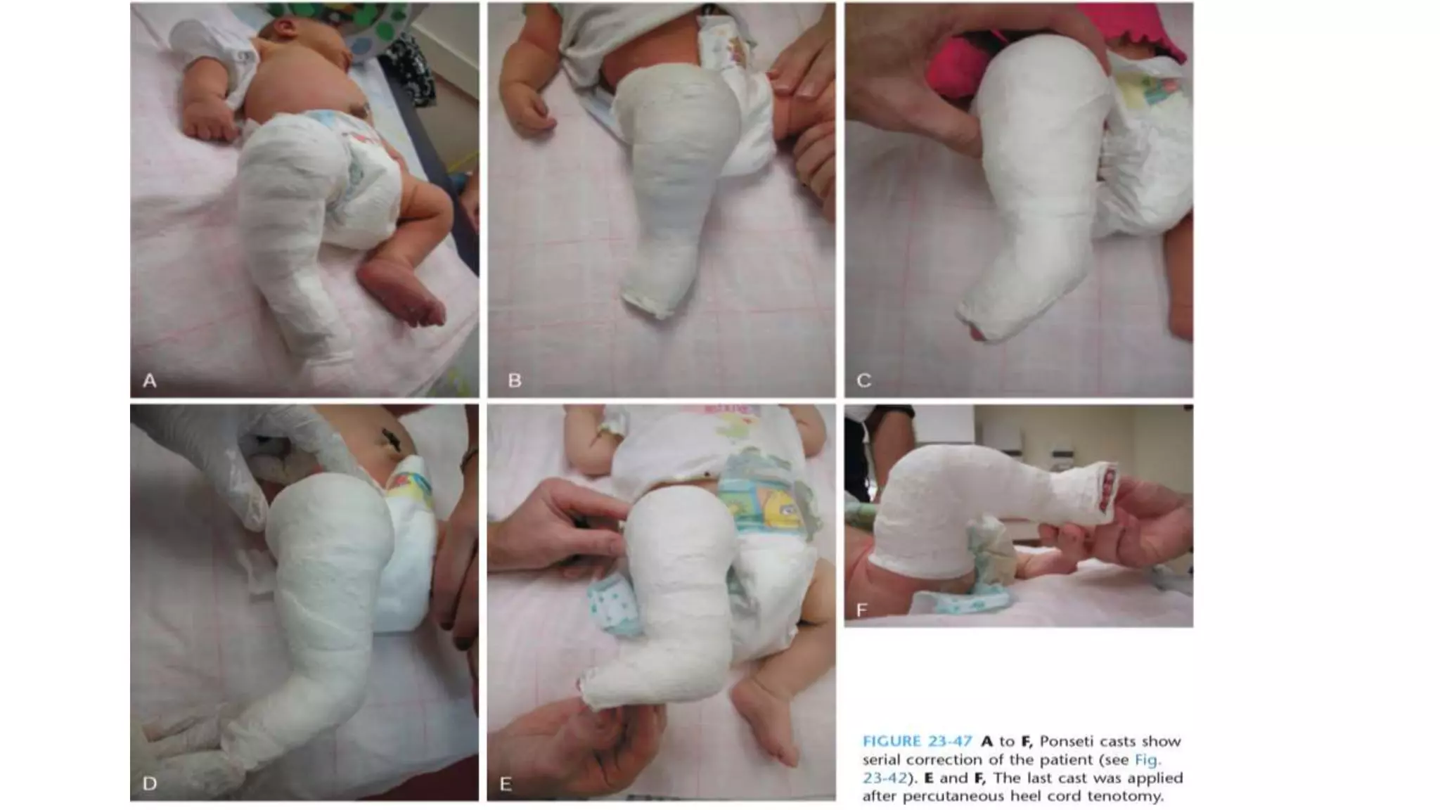 Congenital talipes equinovarus (club foot/ctev) ppt by Dr Pratik | PPTX