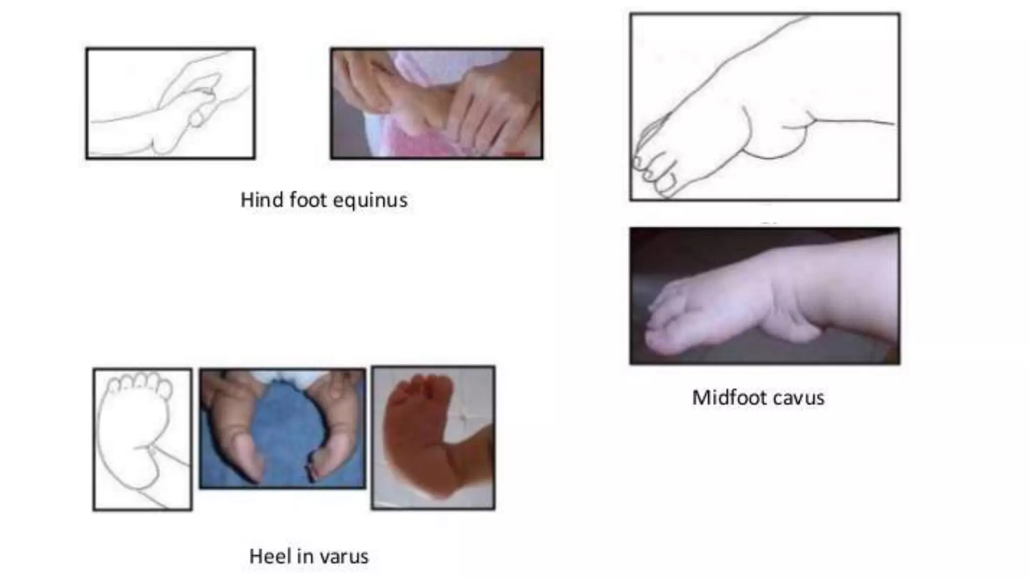 Congenital talipes equinovarus (club foot/ctev) ppt by Dr Pratik | PPTX