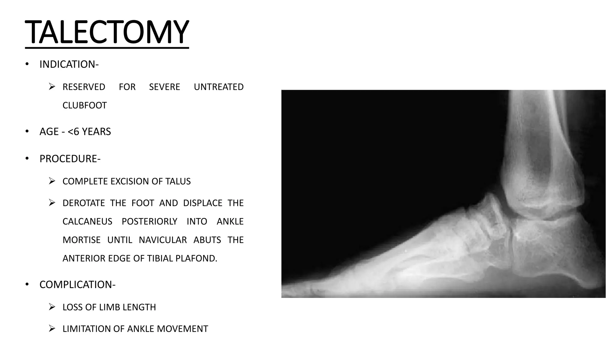 Congenital talipes equinovarus (club foot/ctev) ppt by Dr Pratik | PPTX