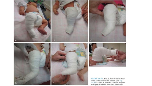 Congenital talipes equinovarus (club foot/ctev) ppt by Dr Pratik | PPTX ...