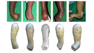 Congenital talipes equinovarus (club foot/ctev) ppt by Dr Pratik | PPTX