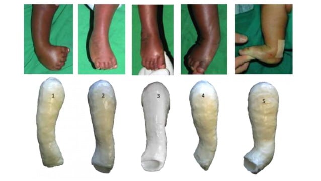Congenital talipes equinovarus (club foot/ctev) ppt by Dr Pratik | PPTX ...