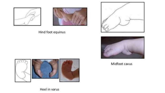 Congenital talipes equinovarus (club foot/ctev) ppt by Dr Pratik | PPTX ...