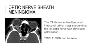 Ct findings in orbital tumours.pptx