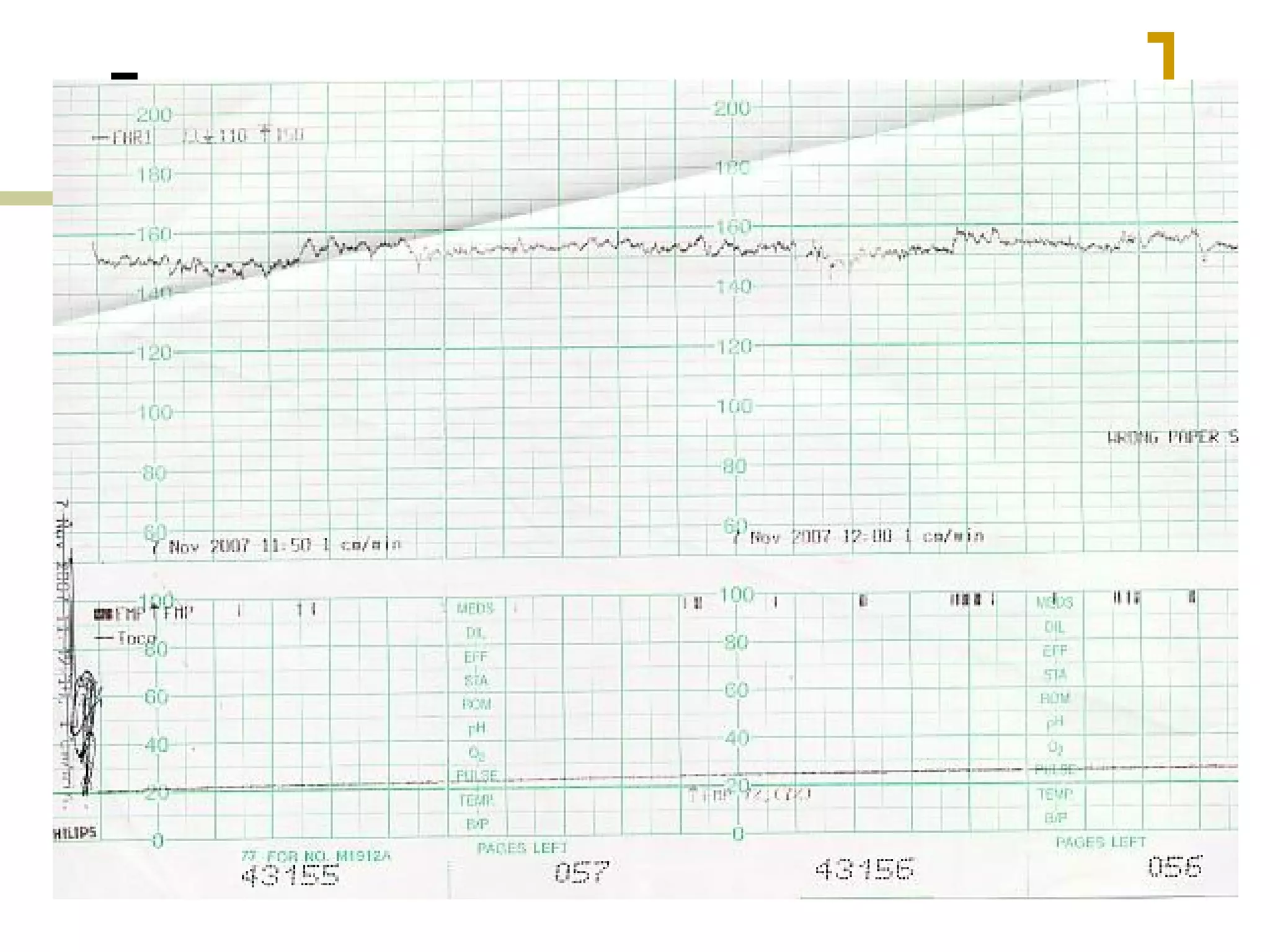 Cardiotocography (CTG) | PPT | Pregnancy | Reproductive Health