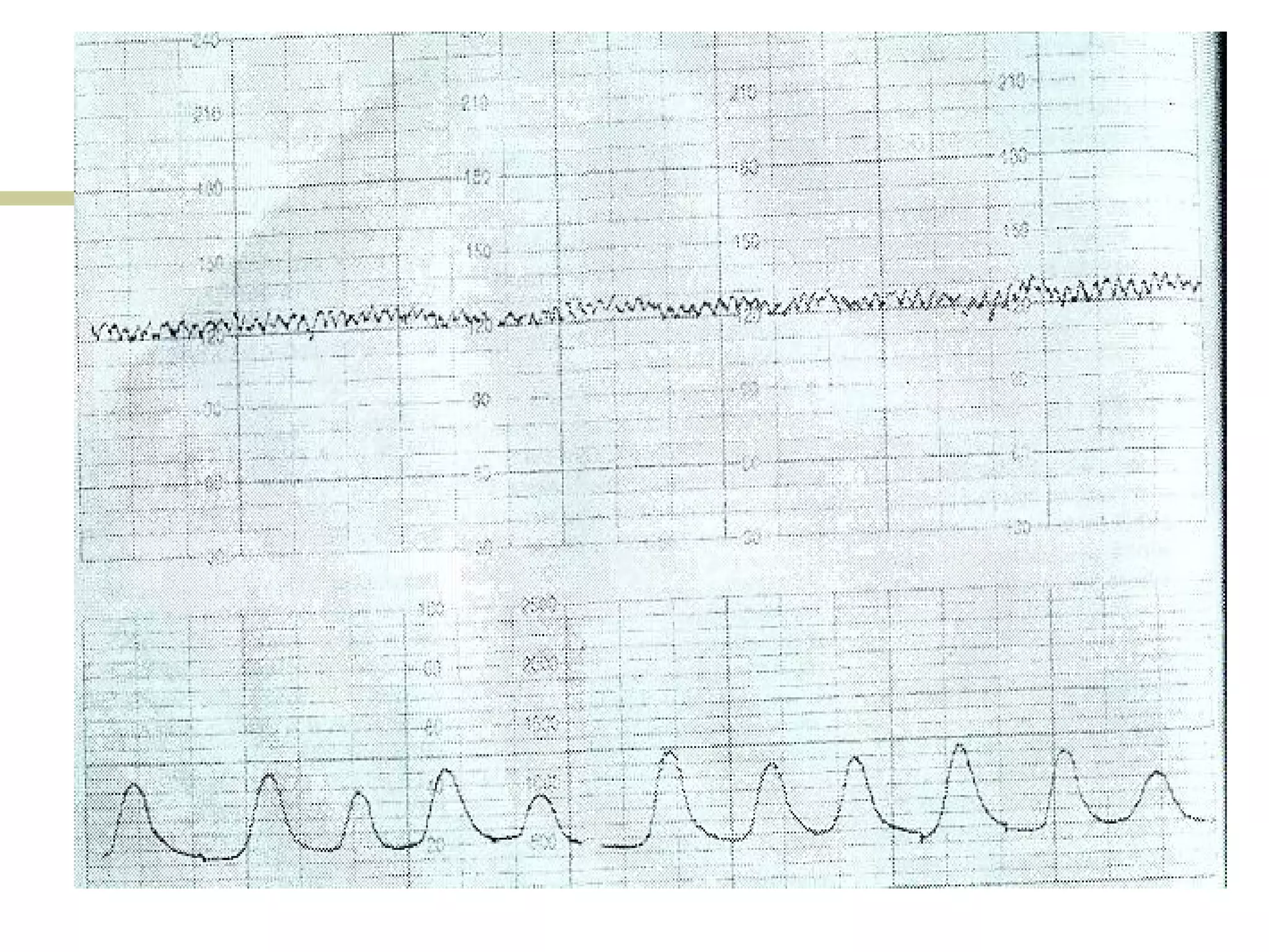 Cardiotocography (CTG) | PPT