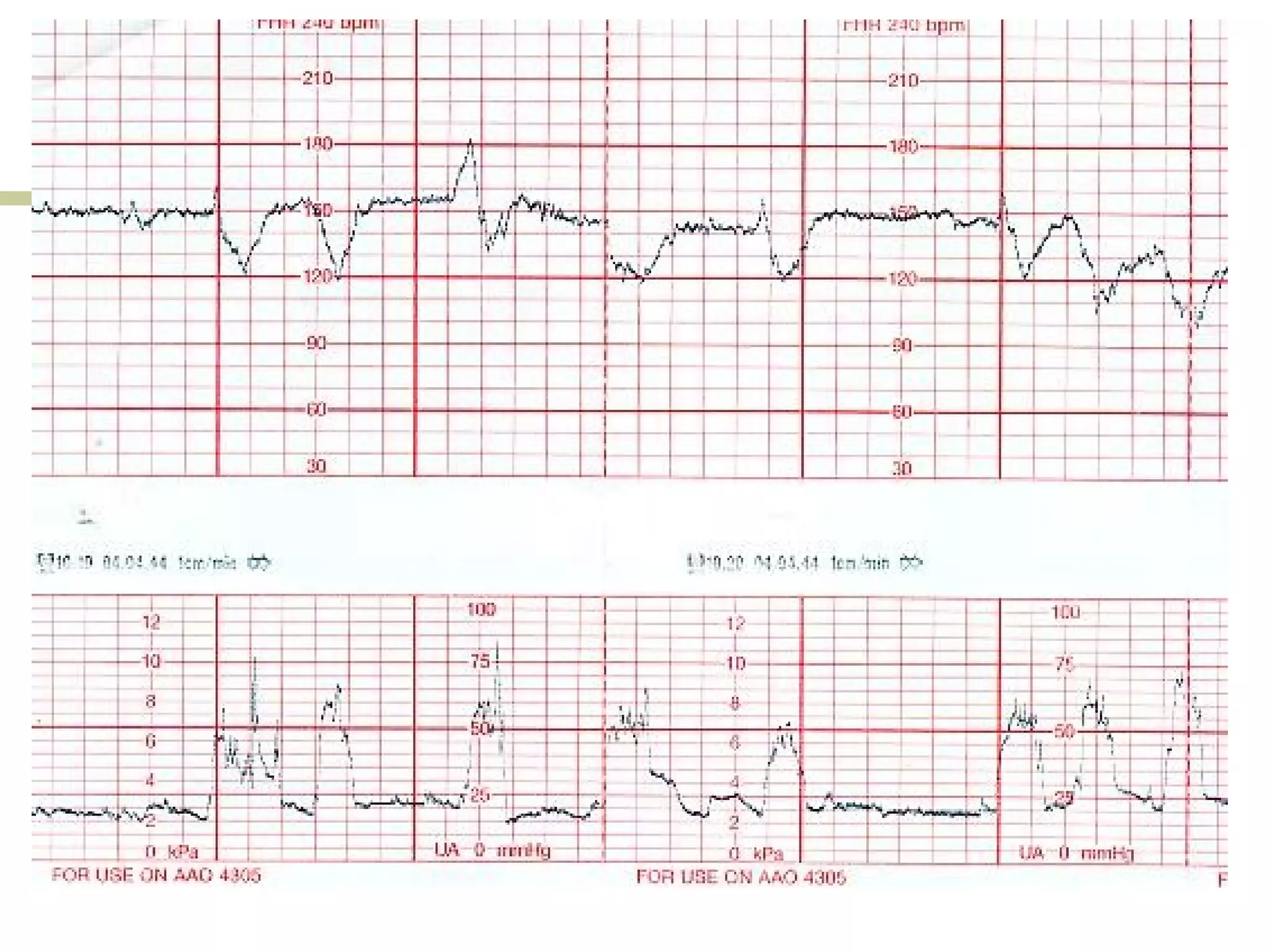 Cardiotocography (CTG) | PPT