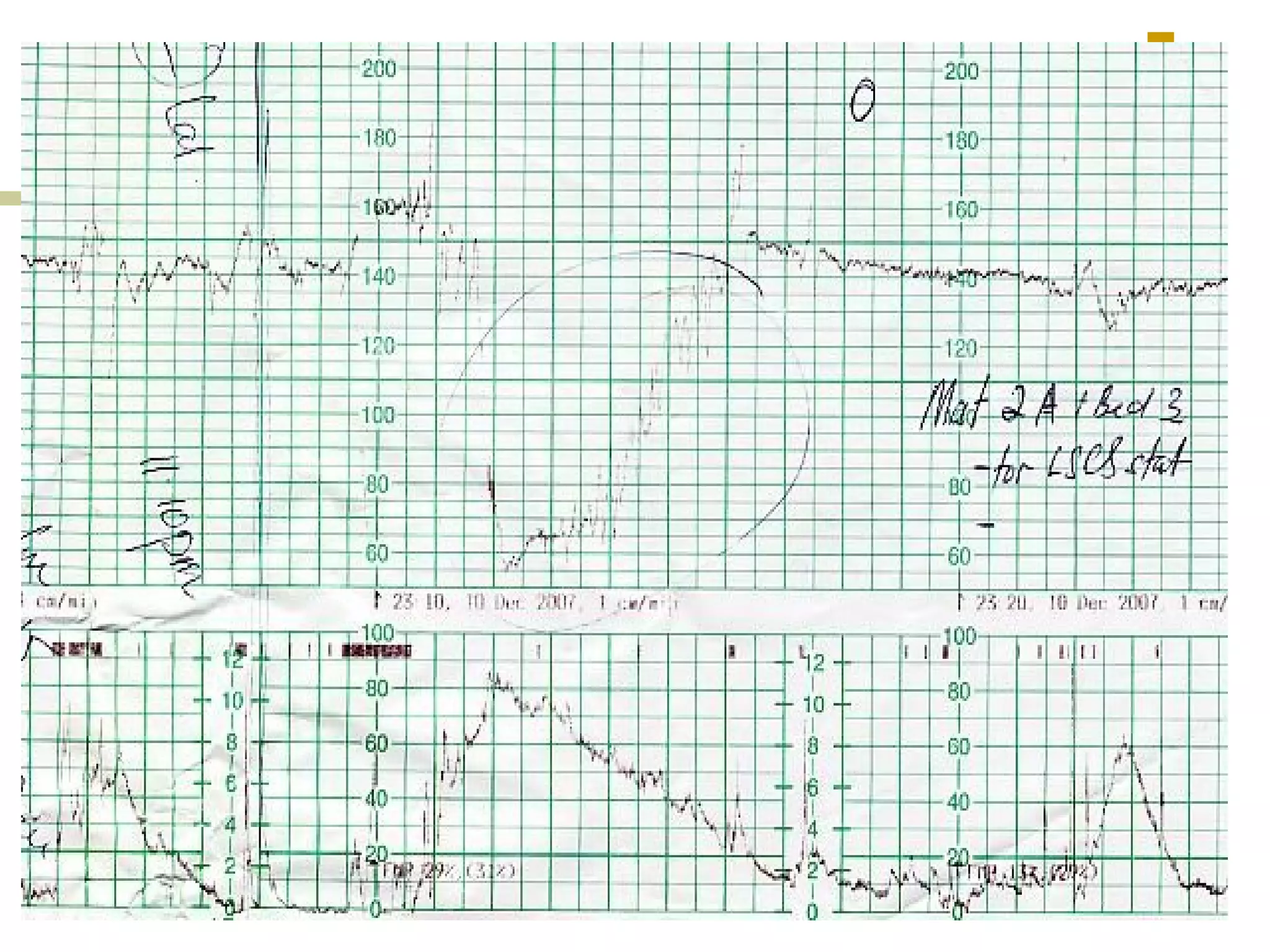 Cardiotocography (CTG) | PPT