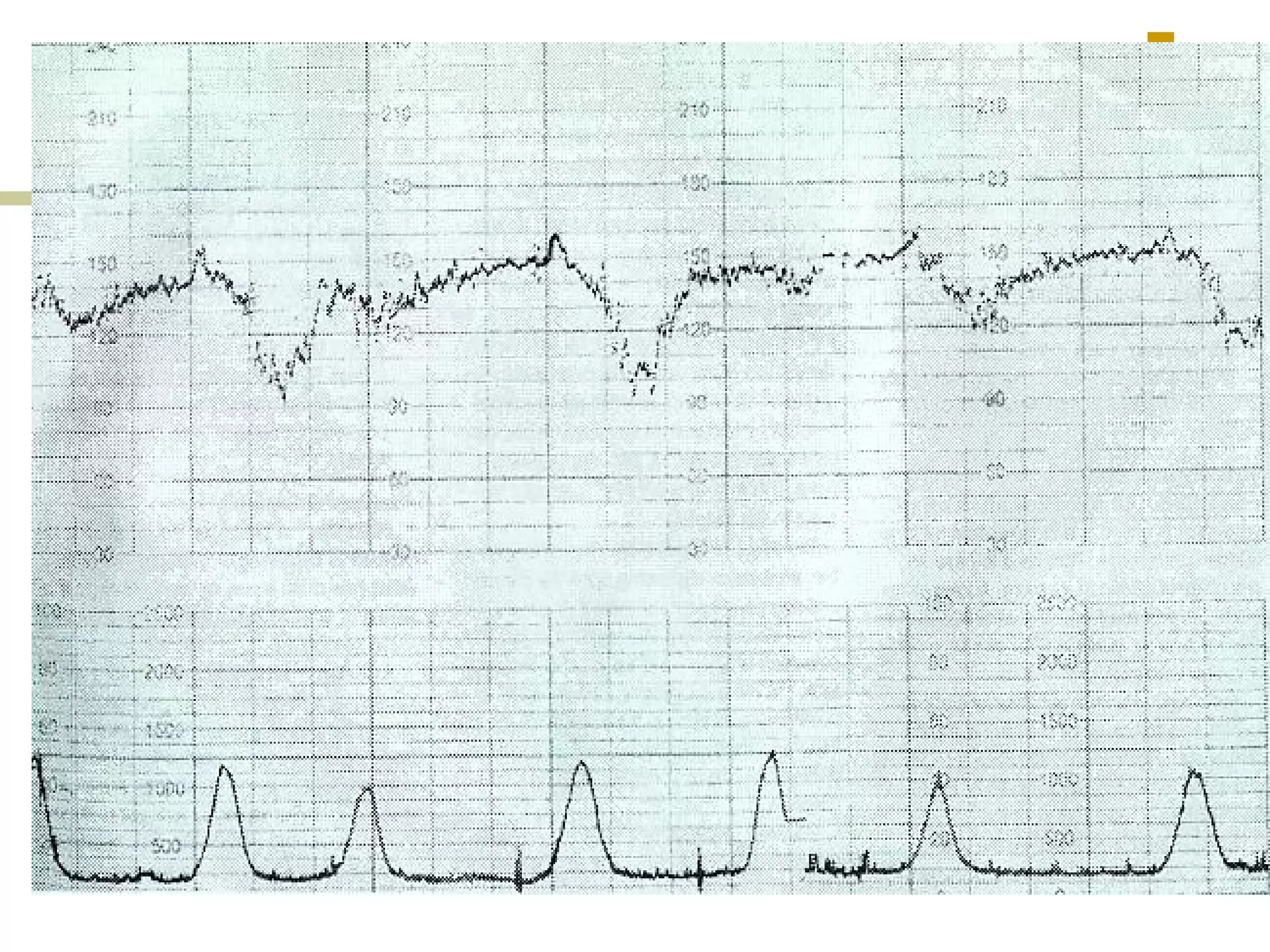 Cardiotocography (CTG) | PPT | Pregnancy | Reproductive Health