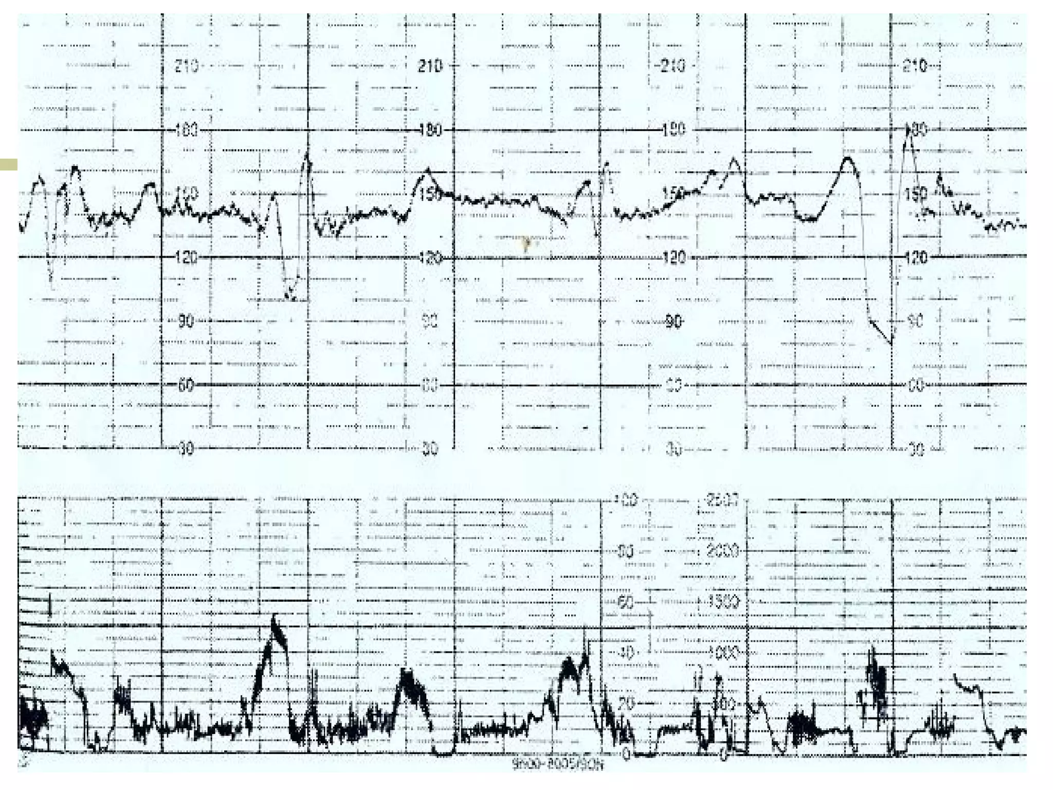 Cardiotocography (CTG) | PPT
