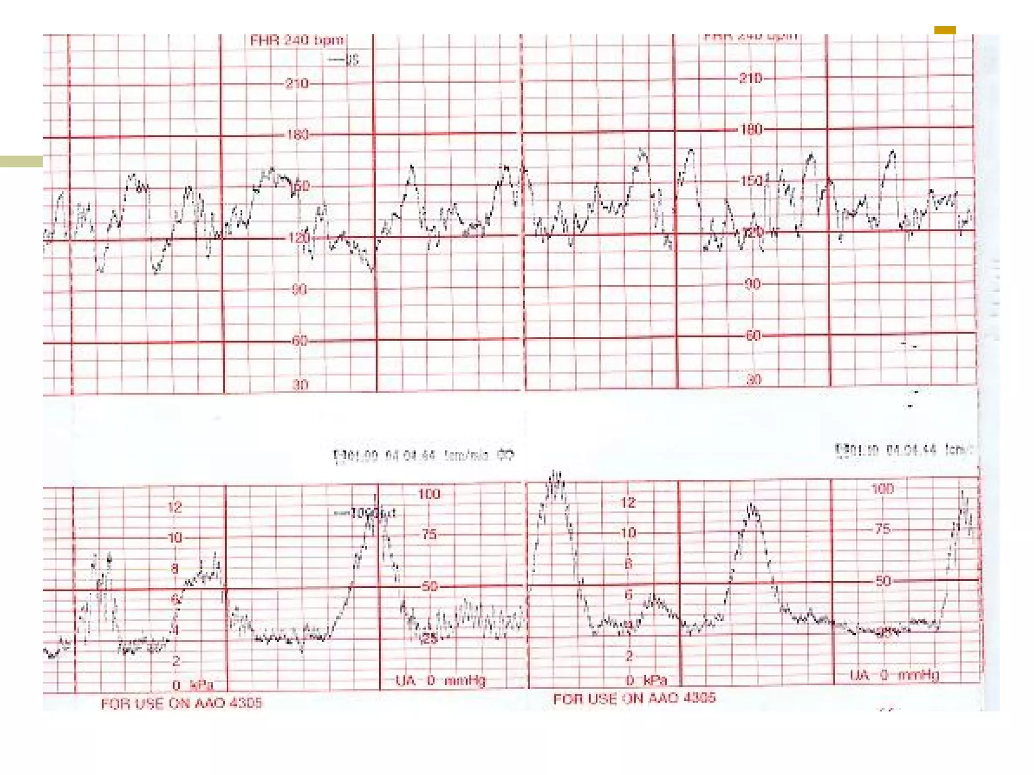 Cardiotocography (CTG) | PPT | Pregnancy | Reproductive Health