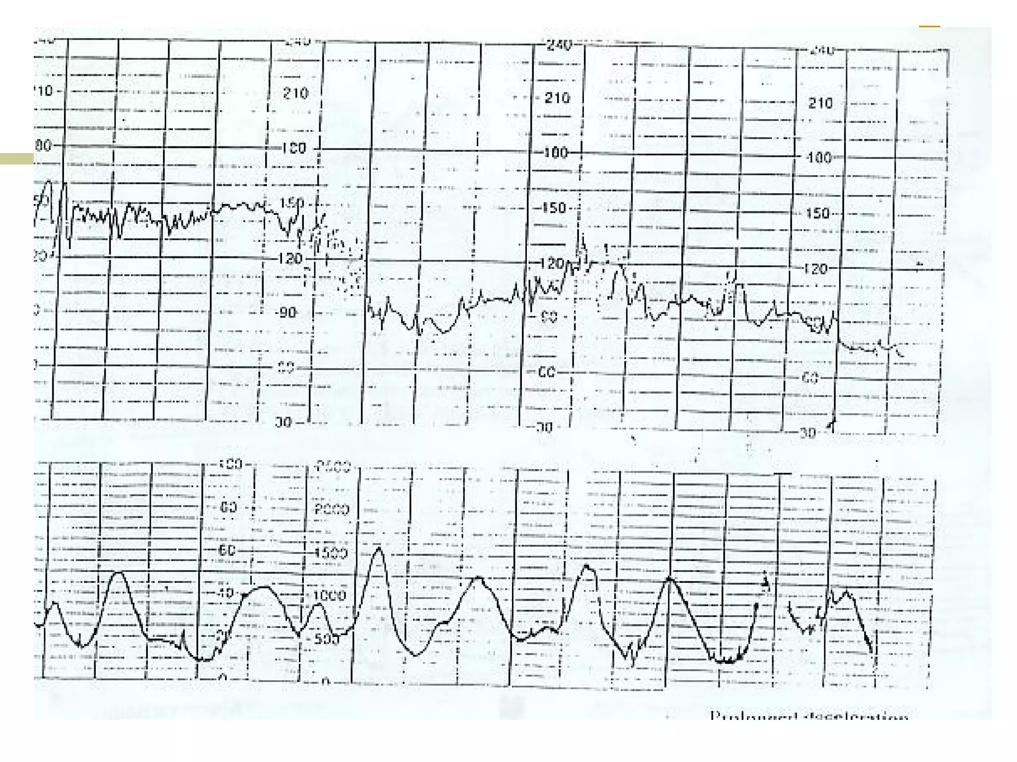 Cardiotocography (CTG) | PPT