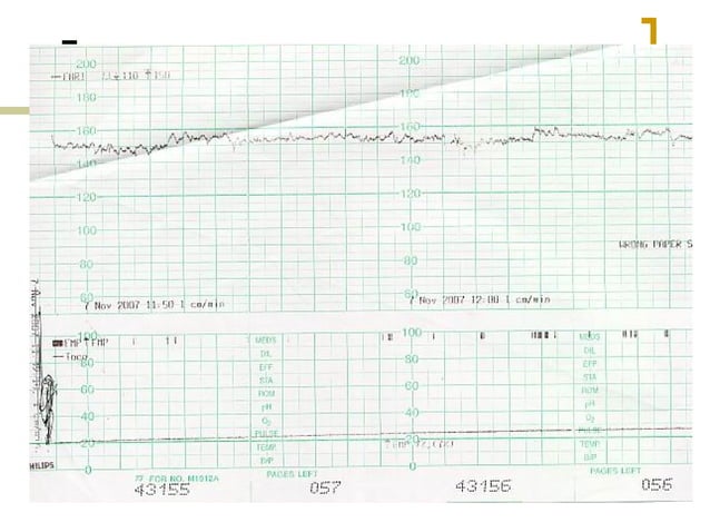 Cardiotocography (CTG) | PPT | Pregnancy | Reproductive Health