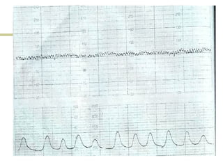 Cardiotocography (CTG) | PPT