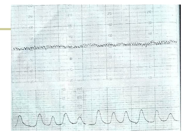 Cardiotocography (CTG) | PPT | Pregnancy | Reproductive Health