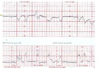 Cardiotocography (CTG) | PPT